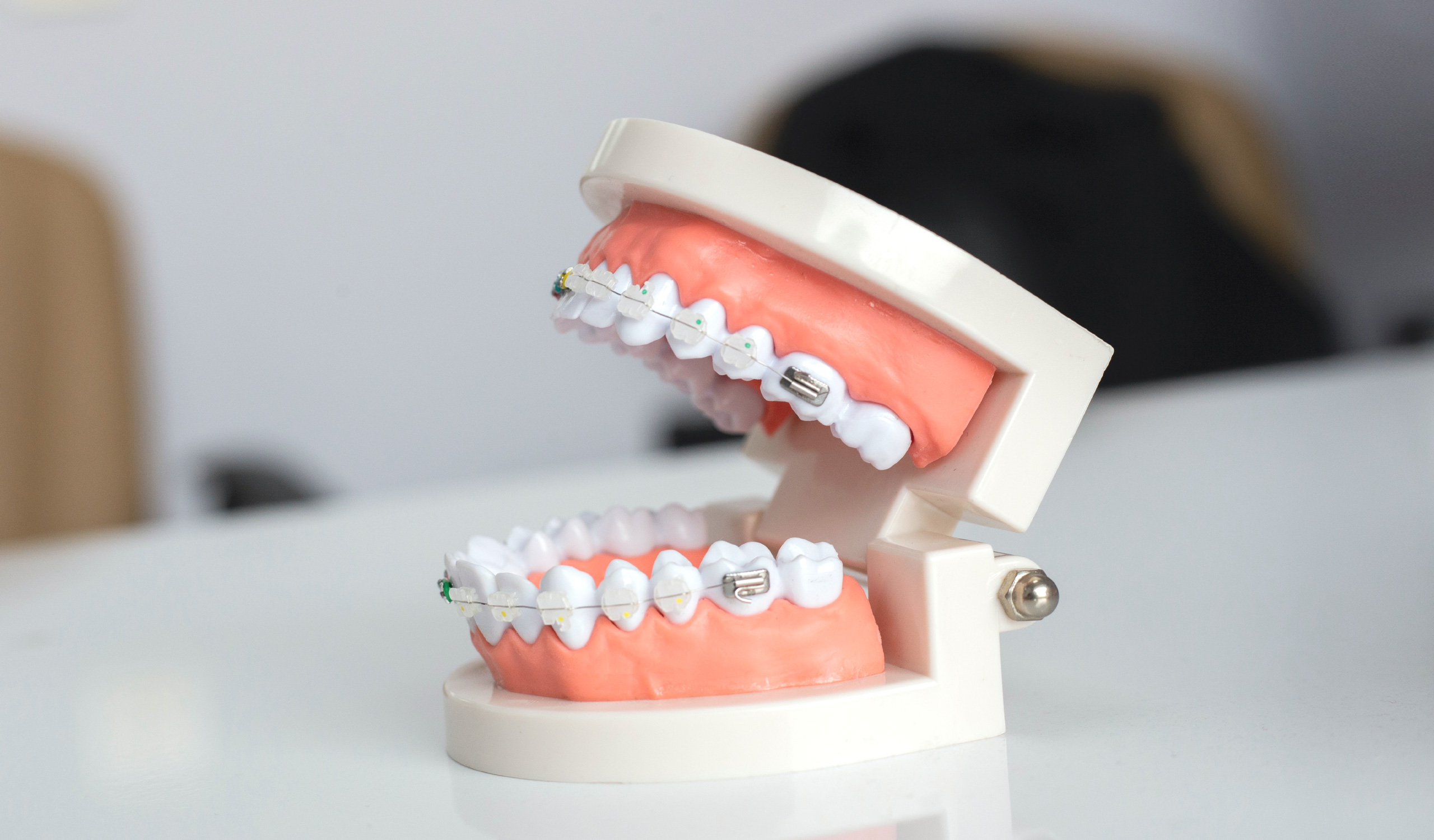 Orthodontic Braces: Types, Costs and Pros and Cons